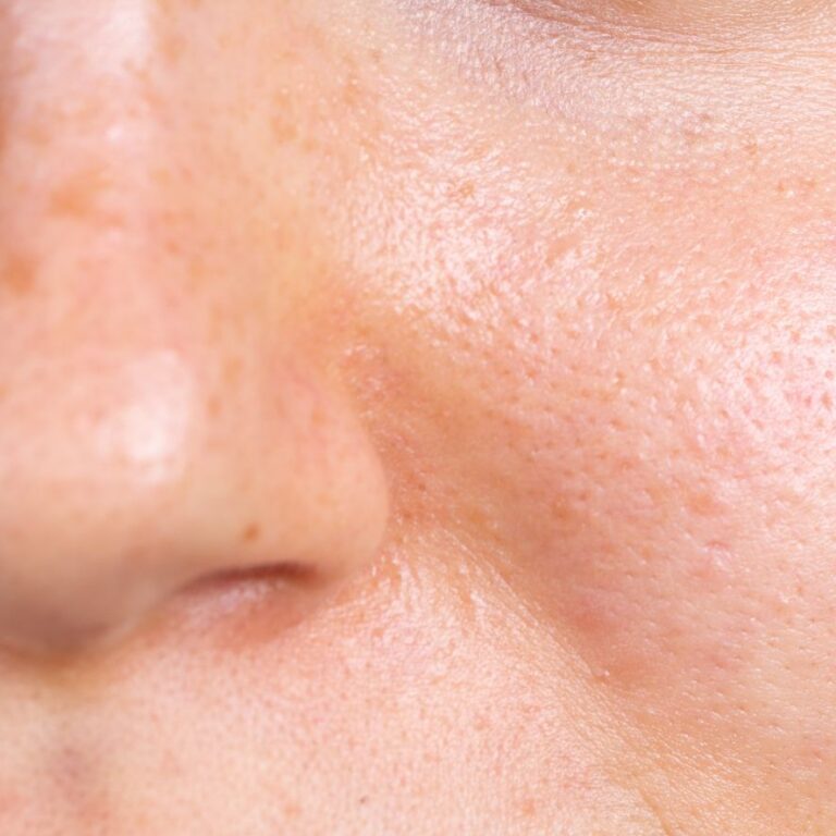 Sydney Laser Redness Treatment - Skin Toning | Lumi Skin Clinics